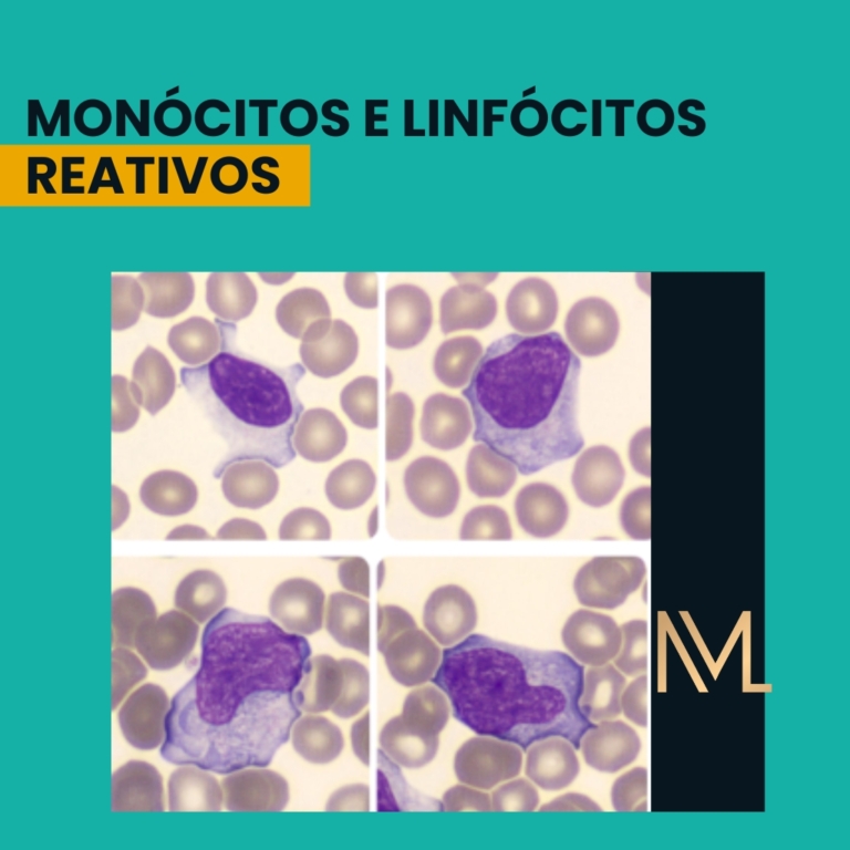 MONÓCITOS E LINFÓCITOS REATIVOS - DIFERENÇAS - INML